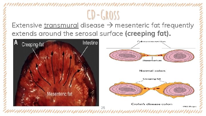 4 Small and Large Intestines Obstructive and vascular