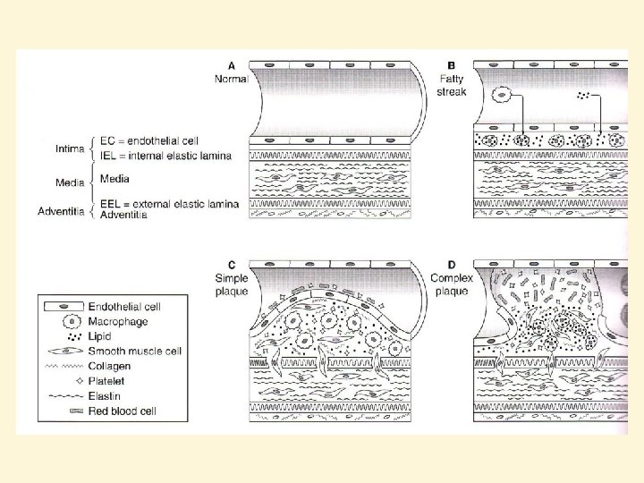 Pathophysiology of atherosclerosis A Normal arterial wall The