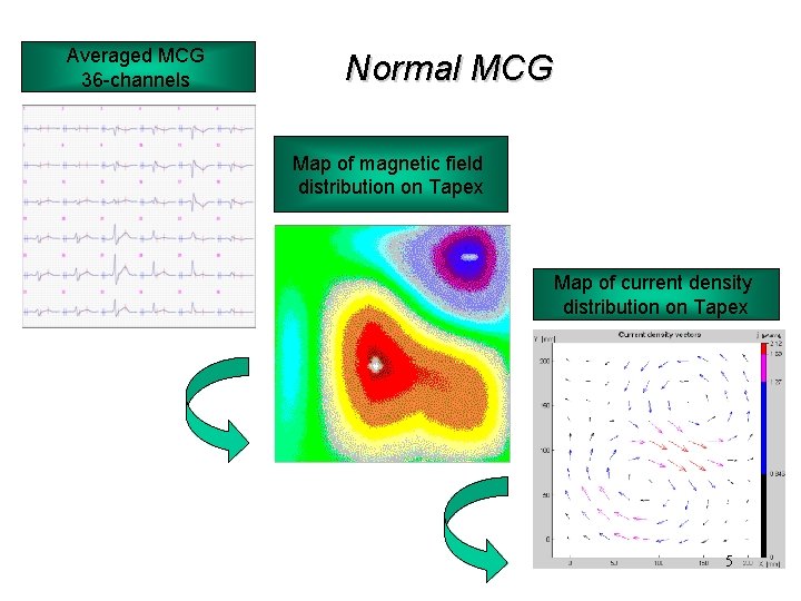 Supersensitive magnetocardiographic system for early recognition ...