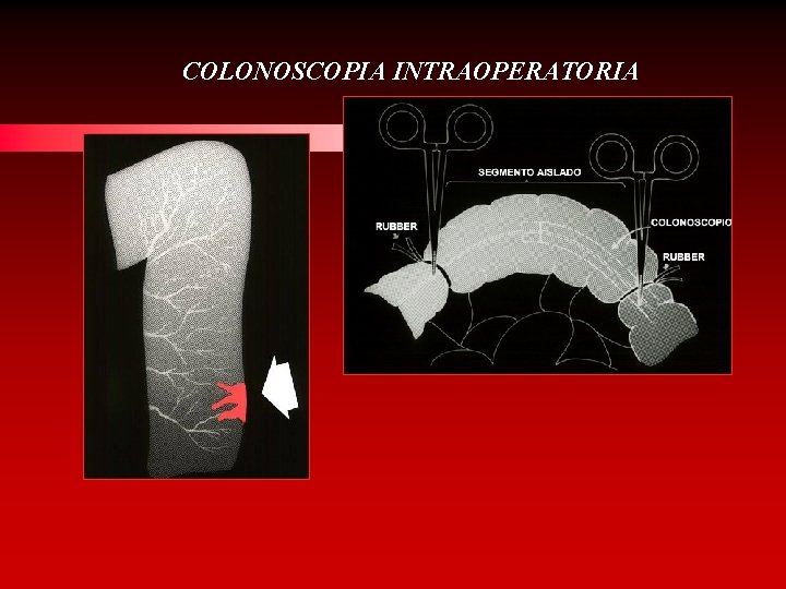 ENFERMEDAD DIVERTICULAR DEL COLON La enfermedad diverticular es