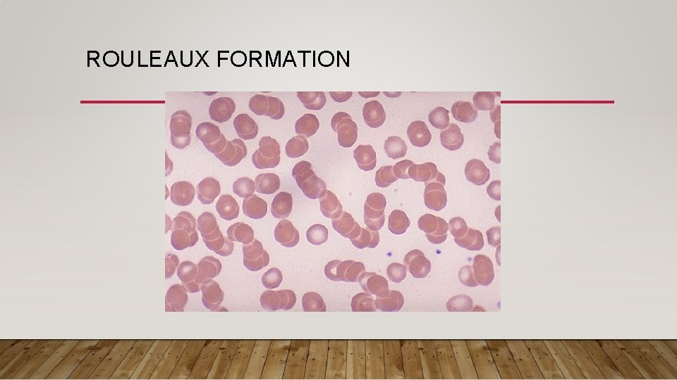 MULTIPLE MYELOMA SUPERVISED BE DR MOHAMMAD ALANI DONE