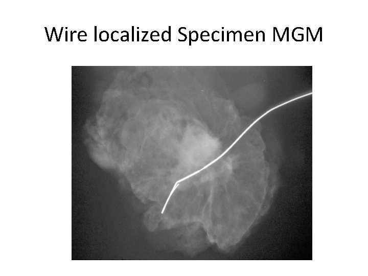 Diagnostic Studies Diagnostic MGM Breast US cystic or