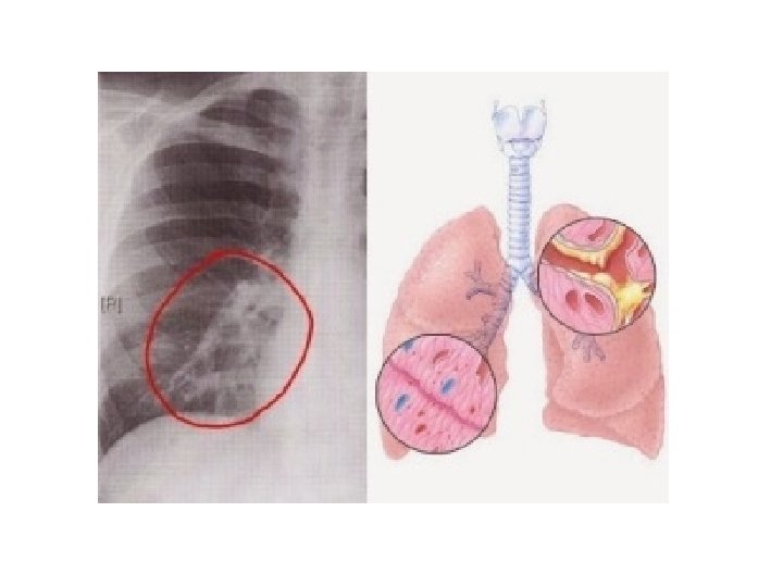 BRONKITIS Oleh dr Irma Susanti Anatomi fisiologi pernafasan