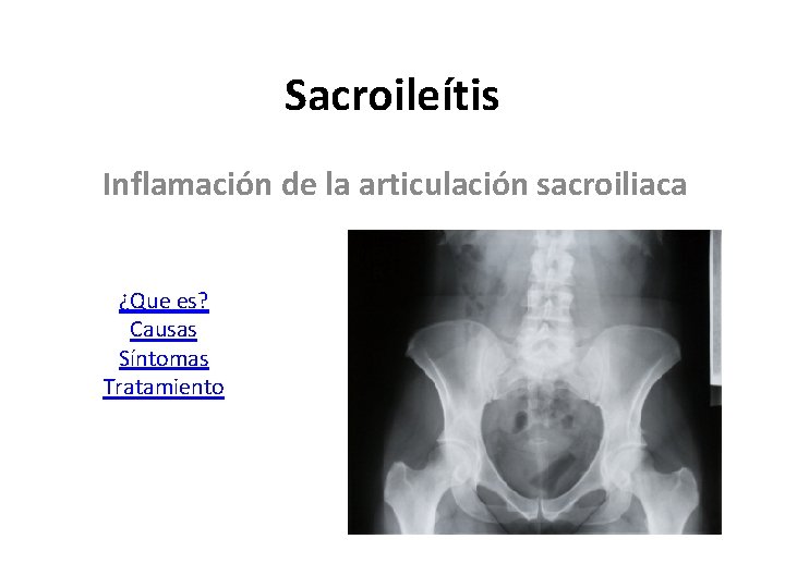 Sacroiletis Inflamacin de la articulacin sacroiliaca Que es