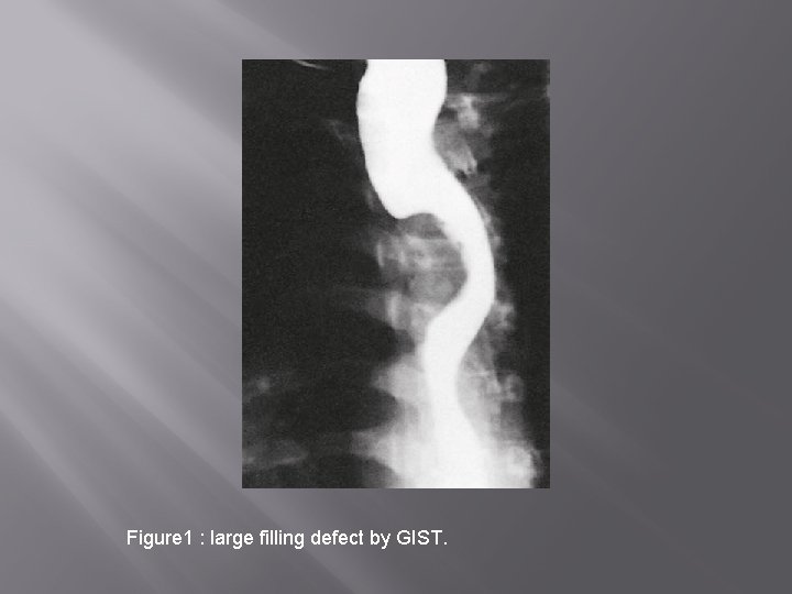 Neoplasms of the esophagus Benign tumors benign epithelial