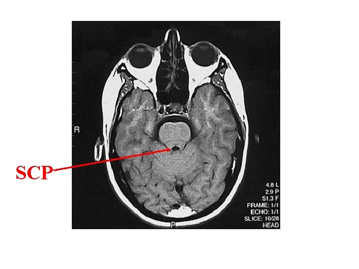 D lesion C B A Two pathways SPINAL