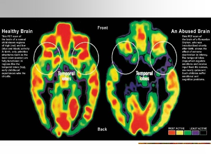 Reactive Attachment Disorder Causes Diagnosis Treatment Basic Trust