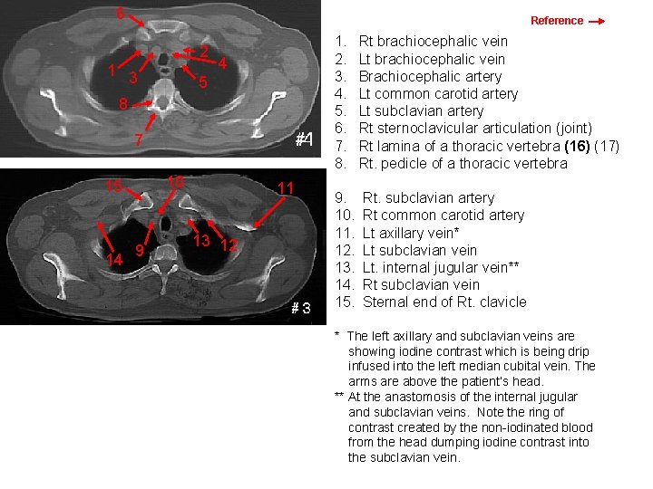 25 Transaxial CT Images of the Thorax These