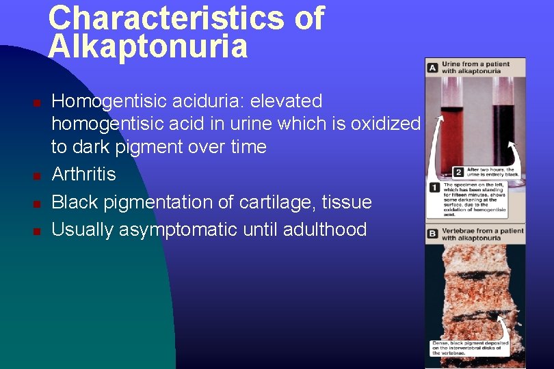 Inborn Errors of Amino Acid Metabolism Renal Block