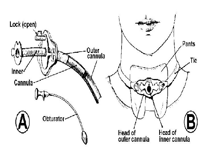 CIRURGIAS DO TRATO RESPIRATRIO TRAQUEOSTOMIA o procedimento cirrgico