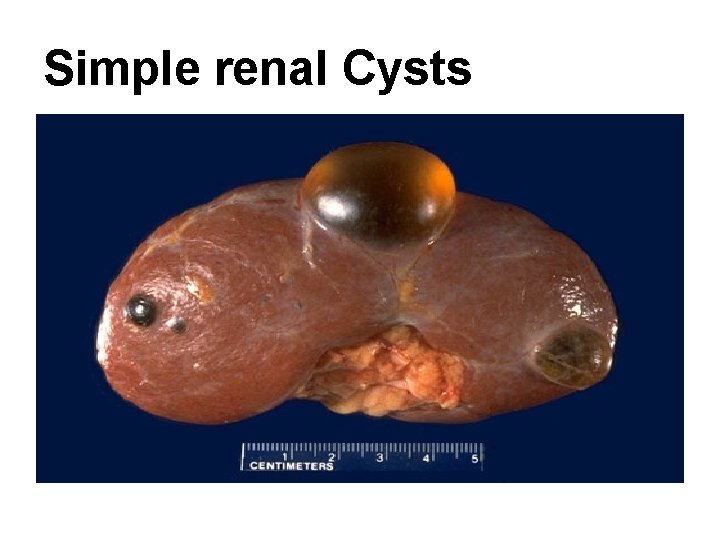 CYSTIC DISEASES OF THE KIDNEY 1 Types 1