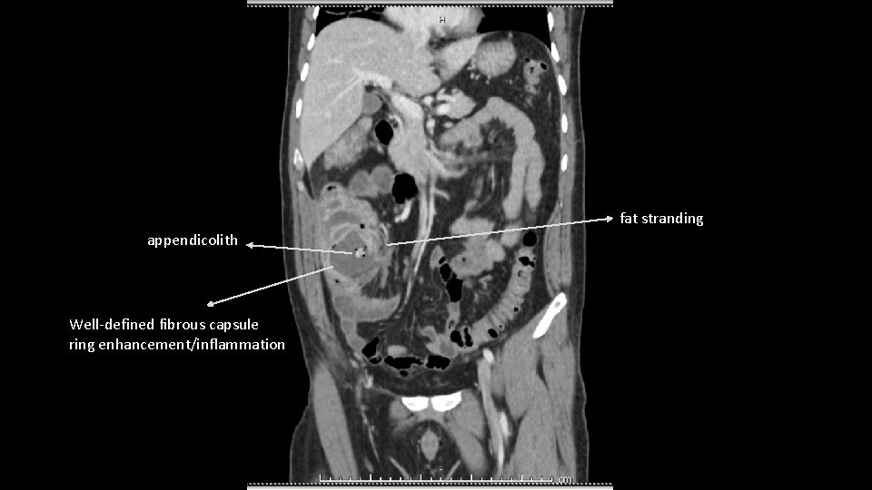 Appendiceal rupture with abscess formation Alexandra Bili Yin