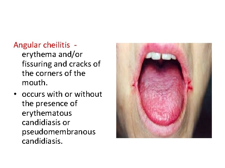 HIV and other retroviral diseases related oral infections