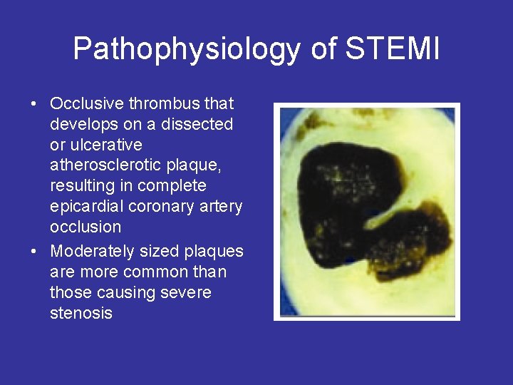 Internal Medicine Board Review Cardiology Acute Coronary Syndrome