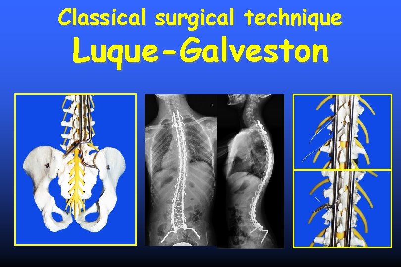 Comparation between pedicle and sacroiliac screws versus sublaminar