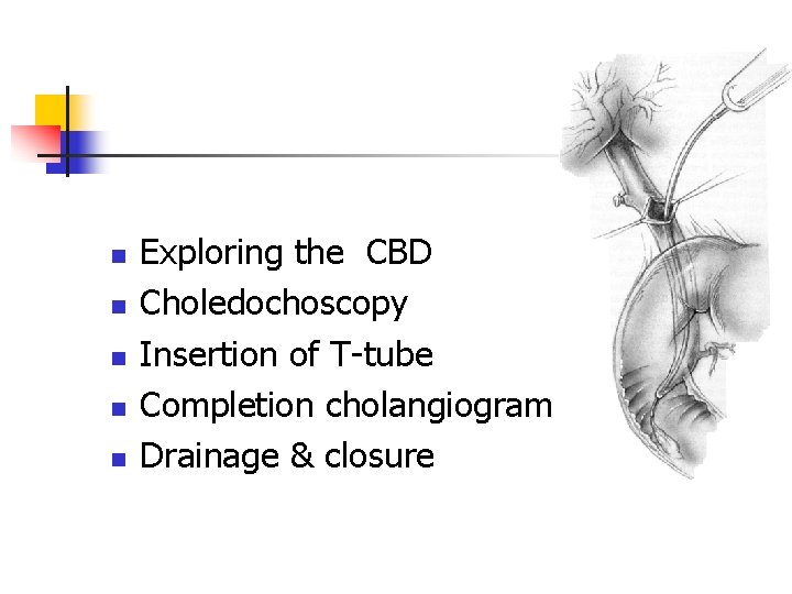 Operative Surgery of the Gallbladder and Biliary Tree
