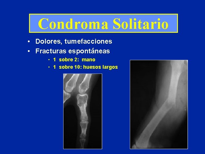 Los Tumores Cartilaginosos Tumores benignos Exostosis osteognicas Condromas