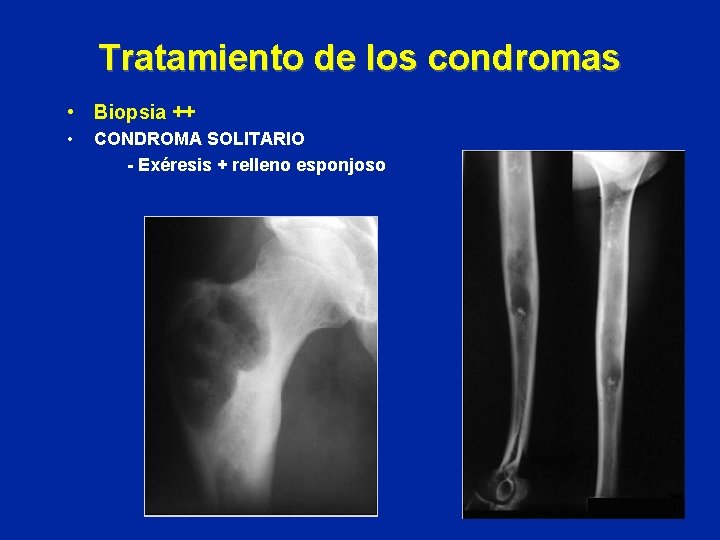Los Tumores Cartilaginosos Tumores benignos Exostosis osteognicas Condromas