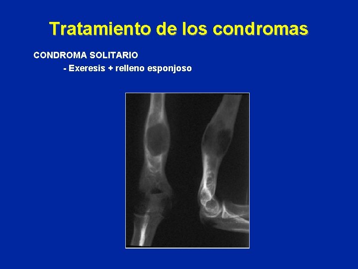 Los Tumores Cartilaginosos Tumores benignos Exostosis osteognicas Condromas