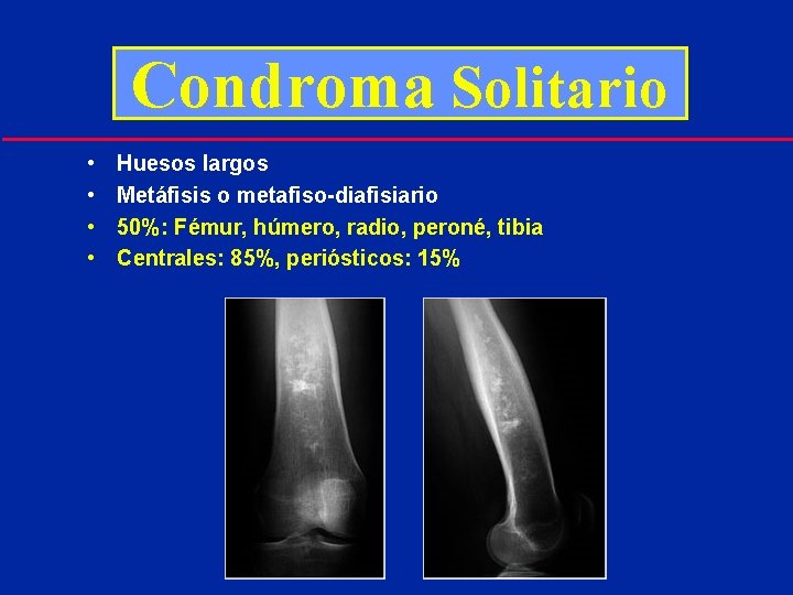 Los Tumores Cartilaginosos Tumores benignos Exostosis osteognicas Condromas