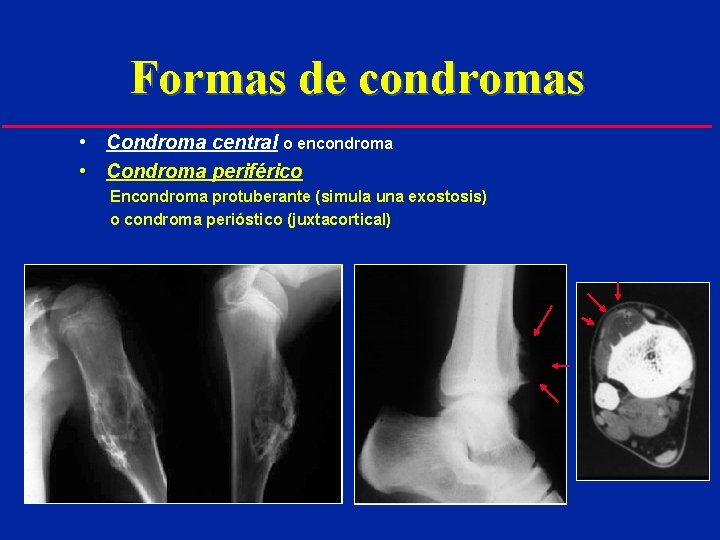 Los Tumores Cartilaginosos Tumores benignos Exostosis osteognicas Condromas