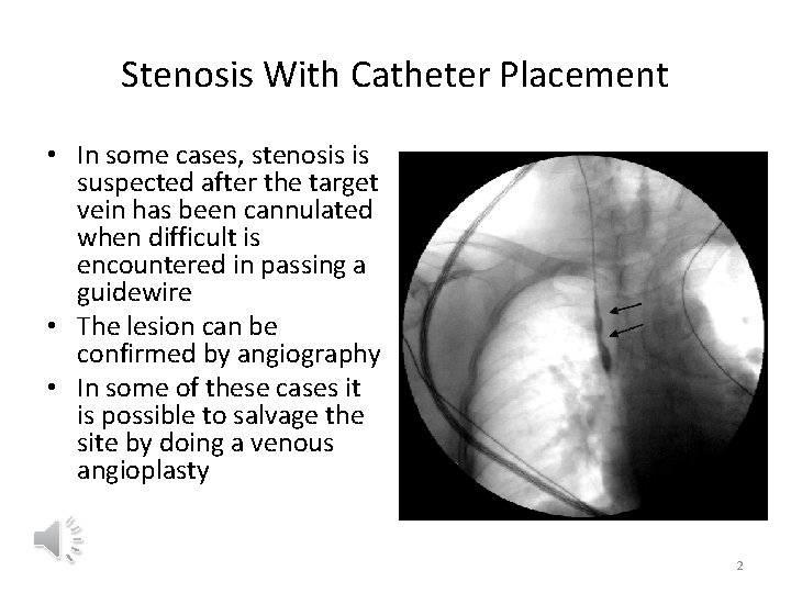 Venous Stenosis Associated with Tunneled Dialysis Catheter Placement