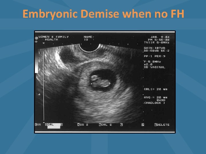 Office Management of Early Pregnancy Loss Objectives Discuss