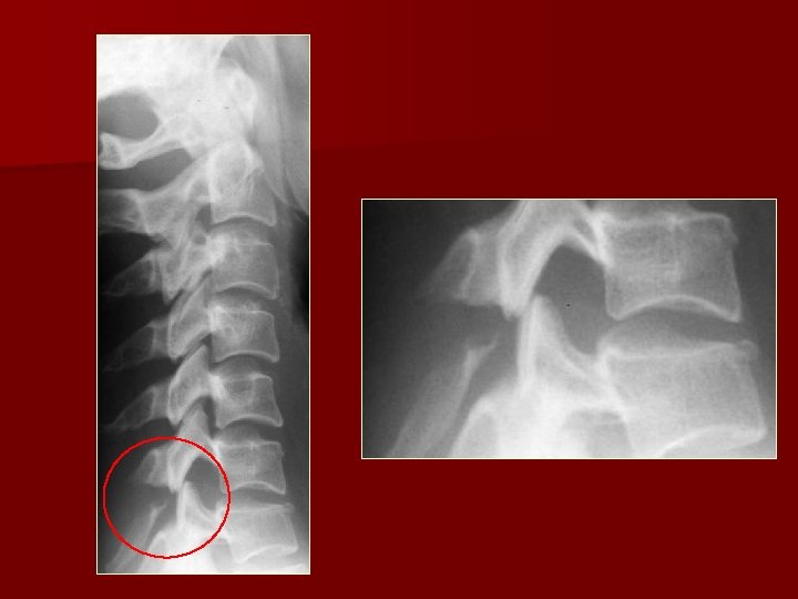 Les Traumatismes du rachis cervical Prsent par Dr