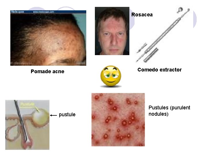Treatment of Acne What is acne l Acne