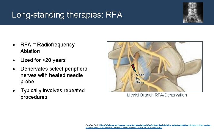 Nonsurgical interventions for the nonoperated back pain patient