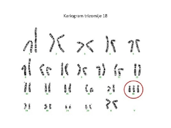 HROMOZOMOPATIJE To su nasljedne bolesti koje nastaju kao