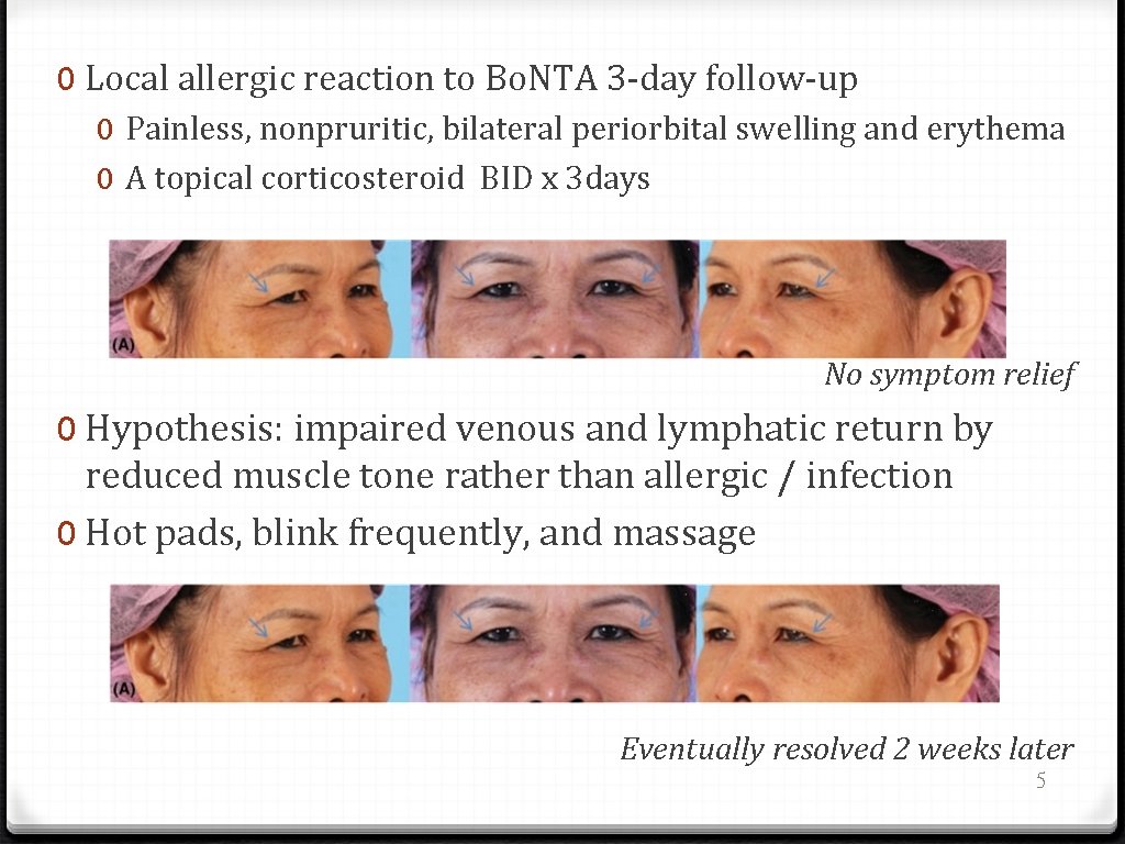 2015 ASPS Nonallergic Eyelid Edema After Botulinum Toxin