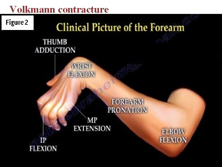 Anatomical basis of Gangloin Contracture Carpal tunnel syndrome