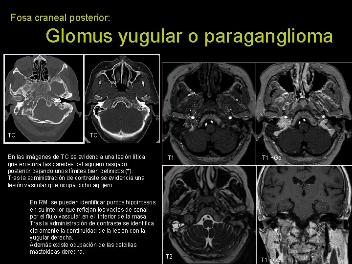 LESIONES FOSA CRANEAL POSTERIOR Frecuentes Neoplasia maligna nasofaringea