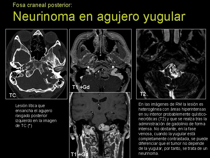 LESIONES FOSA CRANEAL POSTERIOR Frecuentes Neoplasia maligna nasofaringea