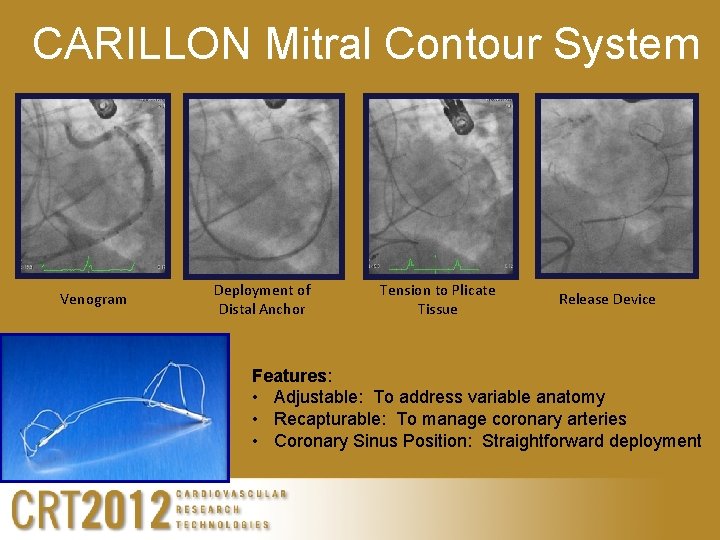 Percutaneous Therapy for Mitral Regurgitation Similarities and Differences