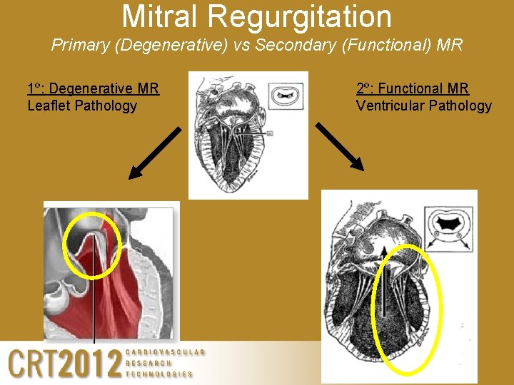 Percutaneous Therapy for Mitral Regurgitation Similarities and Differences
