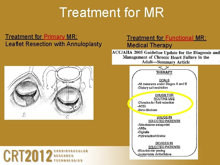 Percutaneous Therapy for Mitral Regurgitation Similarities and Differences