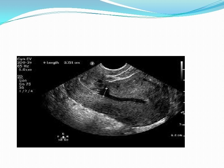 Cesarian scar defect DR NooshinEshraghi PerinatologistIran University Akbar
