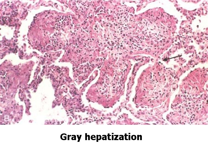 Pulmonary infections pneumonia DR AYSER HAMEED LEC 2