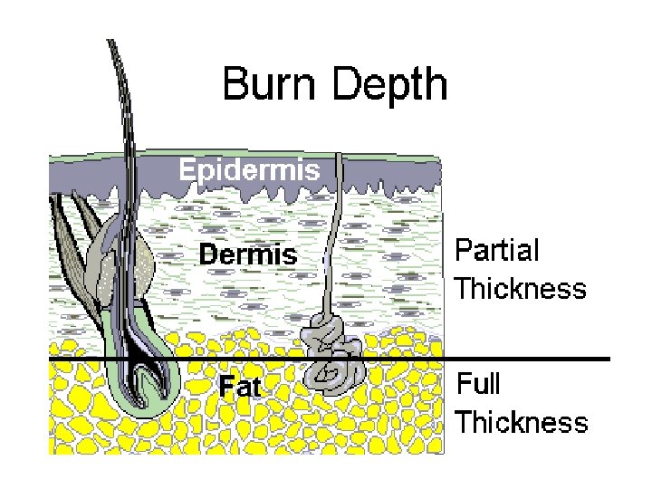 THERMAL INJURIES IN CHILDREN Maryanne Lobo Epidemiology Burns