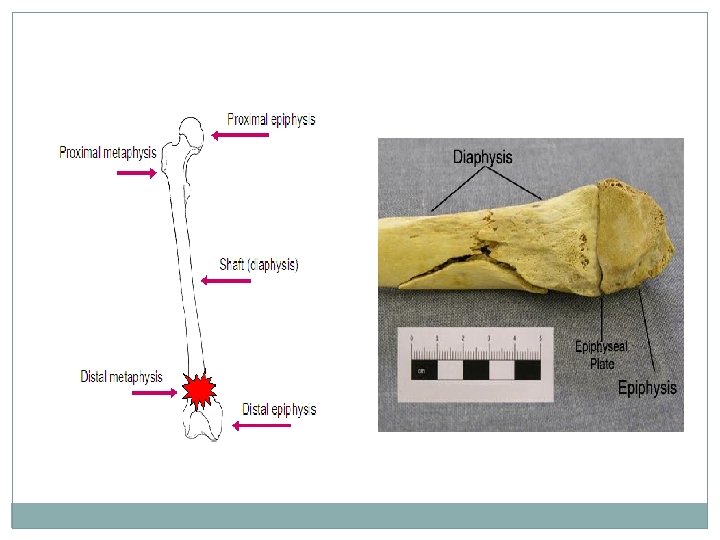 Microbiology of Bone and Joint Infections Osteomyelitis Septic