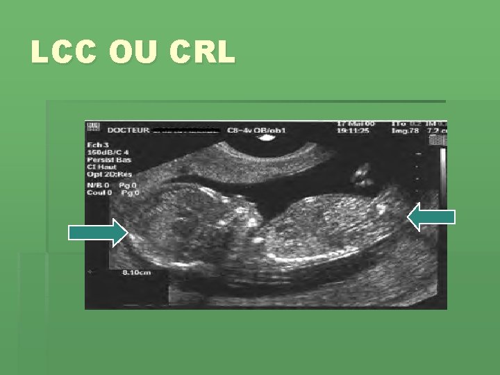 ECHOGRAPHIE BIOMETRIE COURS E S F 2006 BIOMETRIE