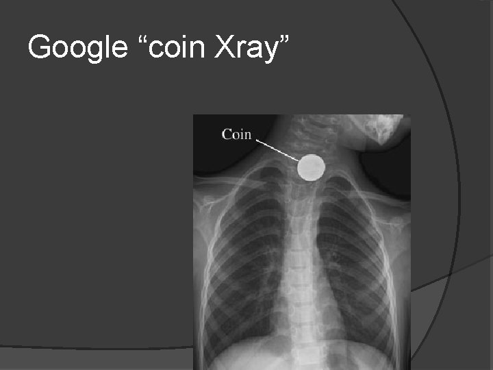 GI The Rob Brandt Review dysphagia Difficulty swallowing