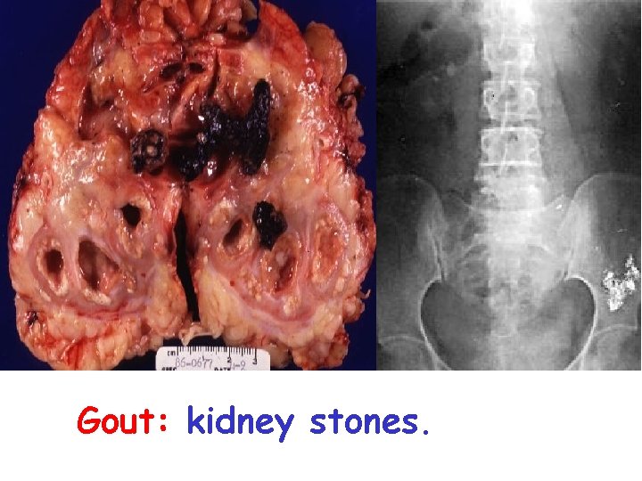 Desorders of nucleotides metabolism 0 5 1 g
