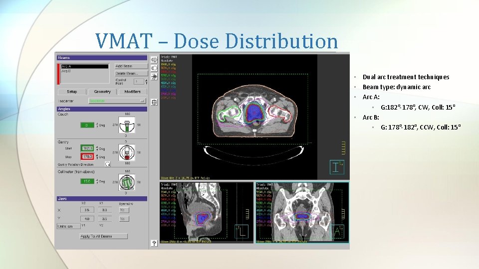 IMRT vs VMAT Prostate Treatment Plan By Jenny