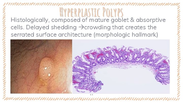 Pathology of The Gastrointestinal tract Ghadeer Hayel MD