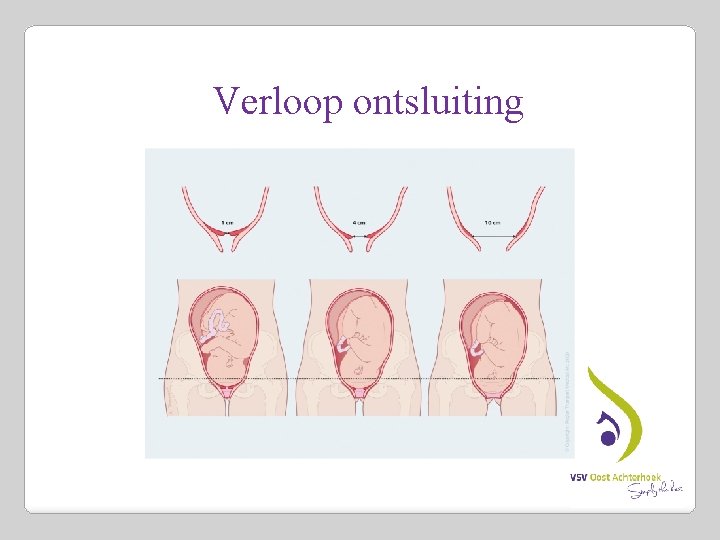 Informatieavond over de bevalling Waaruit bestaat het VSV