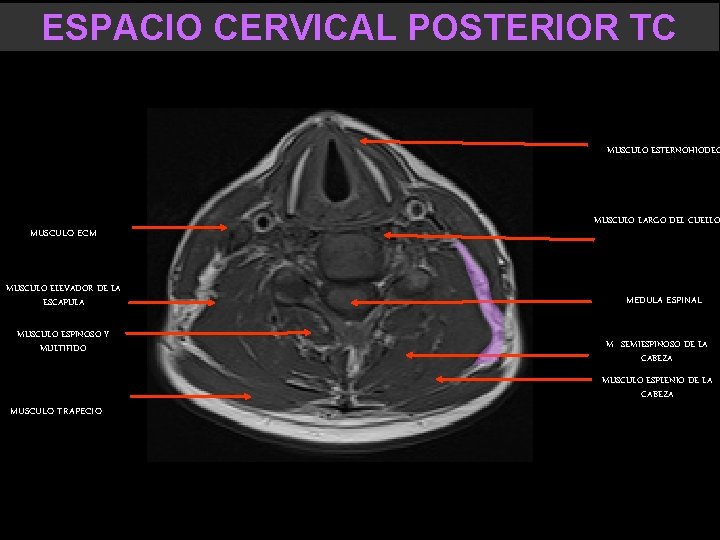 ESPACIO CERVICAL POSTERIOR DEFINICIN Espacio posterolateral contenido graso