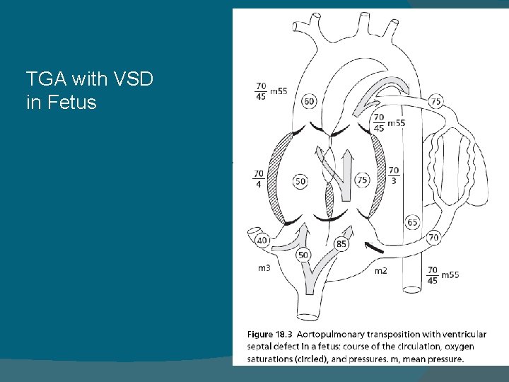 DTGA DR VINOD G V TRANSPOSITION Abnormal origin